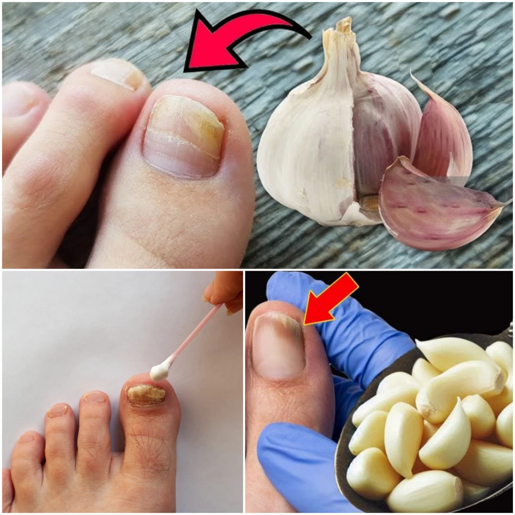 Garlic: The Natural Nail Fungus Killer - News