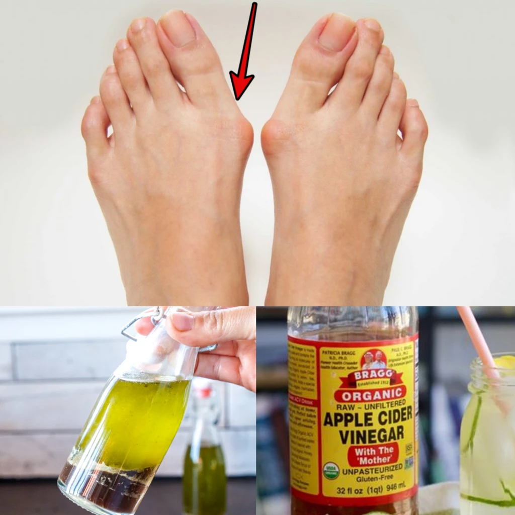 This Will Loosen the Bump in the Foot and Straighten the Protruding ...