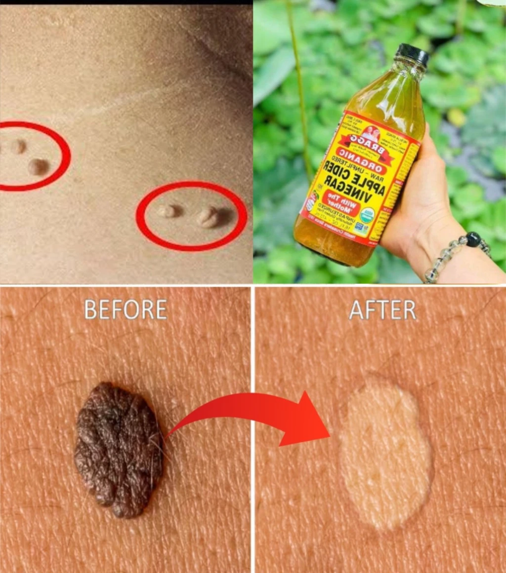 How to Get Rid of Skin Moles at Home Naturally Must express something ...