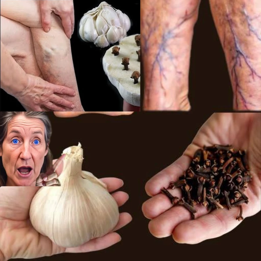 Clove & Garlic: A Natural Remedy for Leg Pain, Rheumatism, and Varicose ...