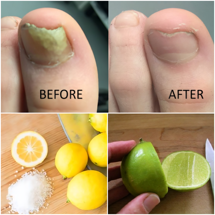 Nail Fungus Removal: 100% Natural Treatment For Toenail Fungus - News