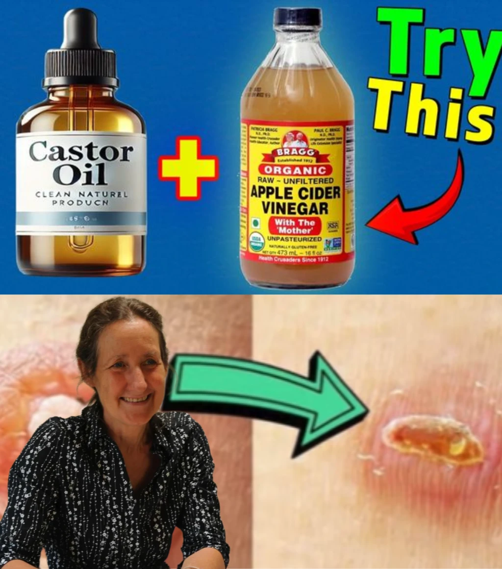 How to Remove a Mole Quickly With Castor Oil 😋*Please - we need your ...