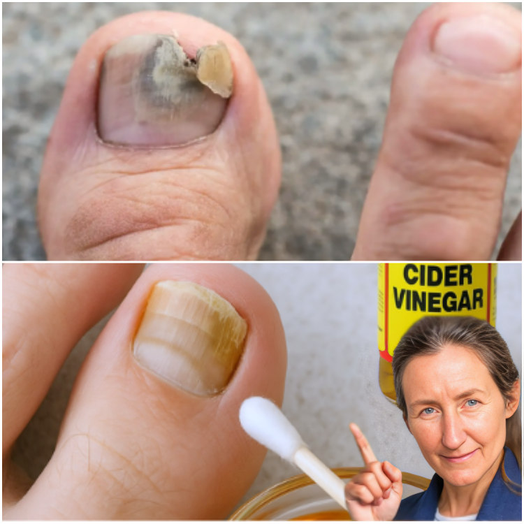 Get Rid of Toenail Fungus in Just 7 Days! Natural Treatment Must ...